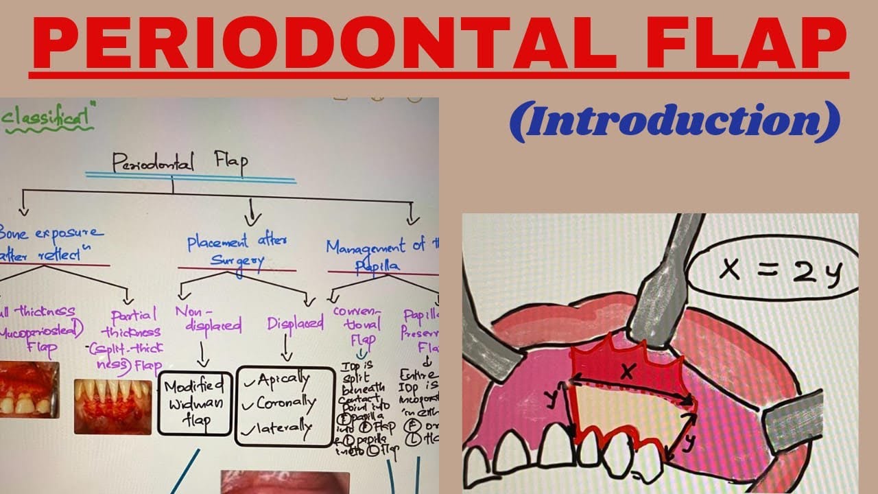 Learn the concised basic idea of flaps..easy to follow - YouTube
