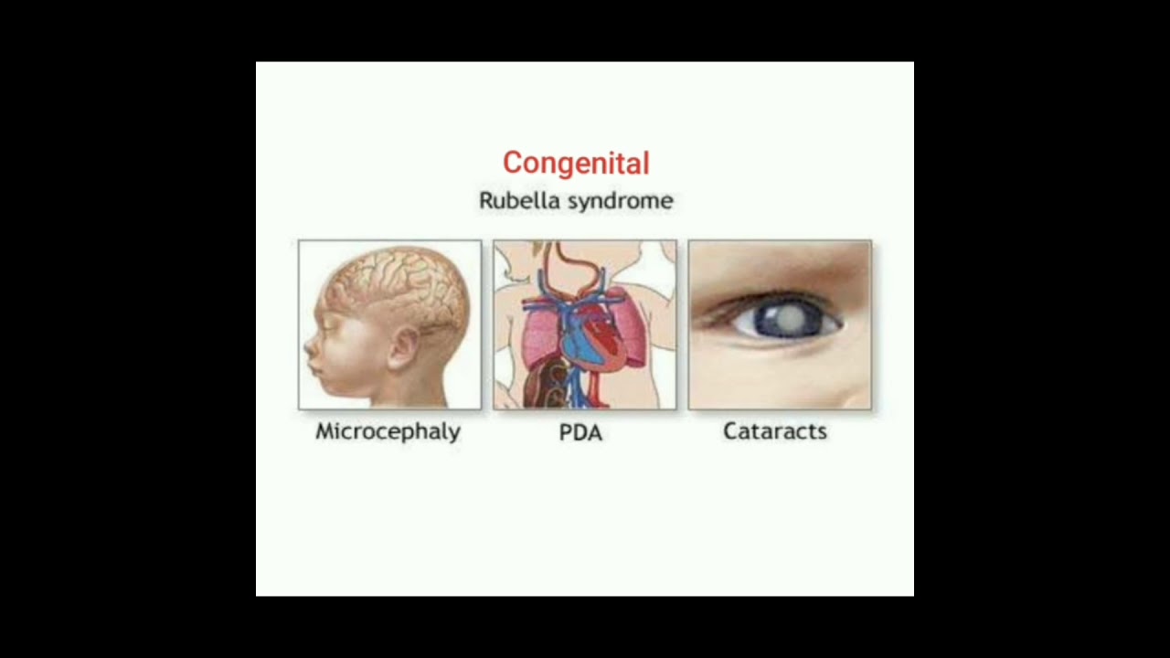 Congenital Rubella Pda