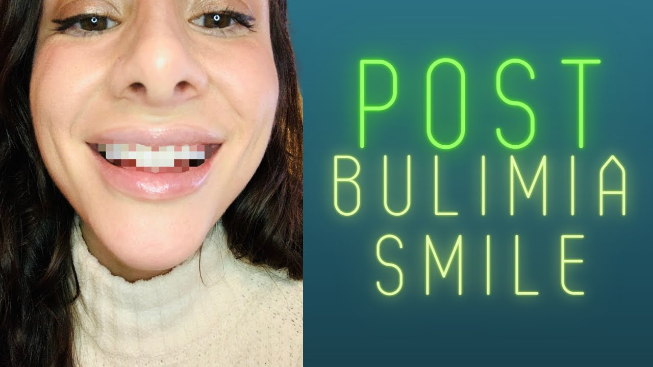 MY SMILE JOURNEY - 13 Years of Bulimia - YouTube