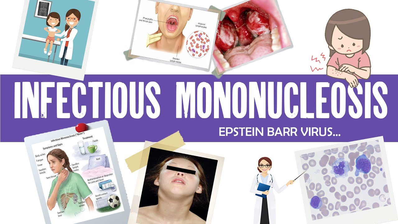 Infectious mononucleosis | Epstein Barr Virus | EBV | Atypical ...