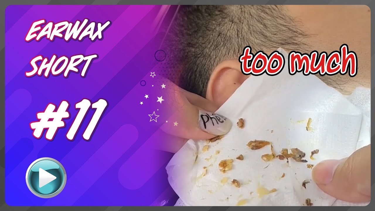 Long time no remove earwax so big ASMR, so comfortable. - YouTube