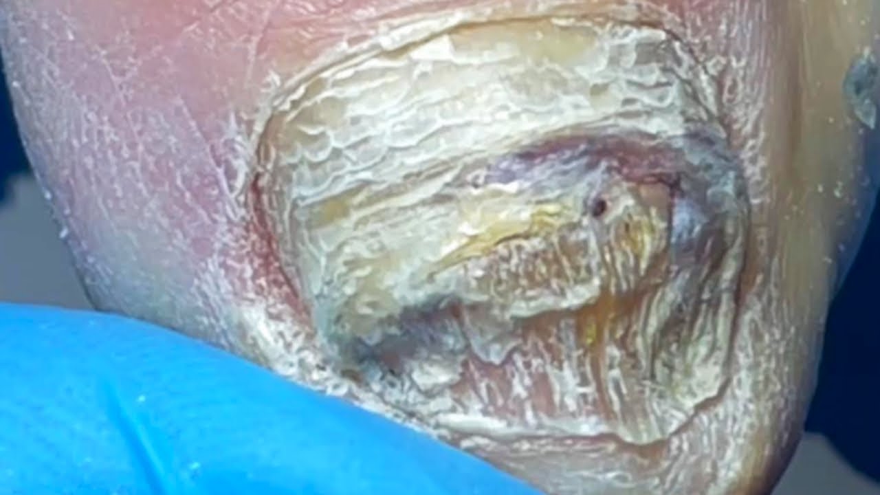Deformed And Deteriorated Onychomycosis, Multiple Trimming【Pedicure ...