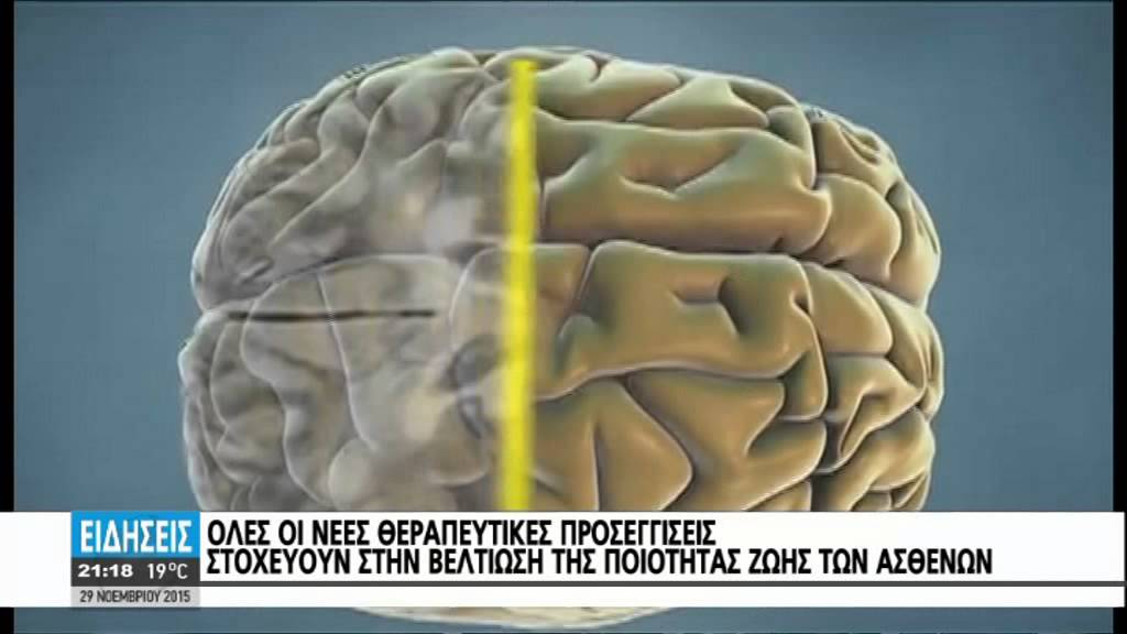 ΣΚΛΗΡΥΝΣΗ ΚΑΤΑ ΠΛΑΚΑΣ: ΜΙΑ ΝΟΣΟΣ ΜΕ ΤΟ ΔΙΚΟ ΤΗΣ ΑΠΟΤΥΠΩΜΑ - YouTube