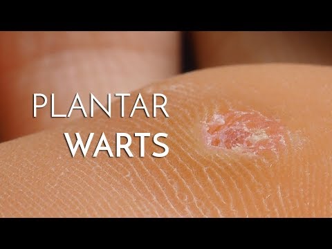 Plantar Warts (Verrucas) - Podiatrist Georgina Tay, East Coast Podiatry