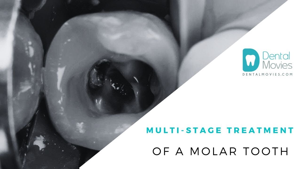Multi stage treatment of a molar tooth - YouTube