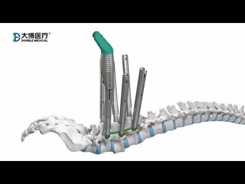 Double Medical: Luna Spine System Minimally Invasive Spine Solution ...