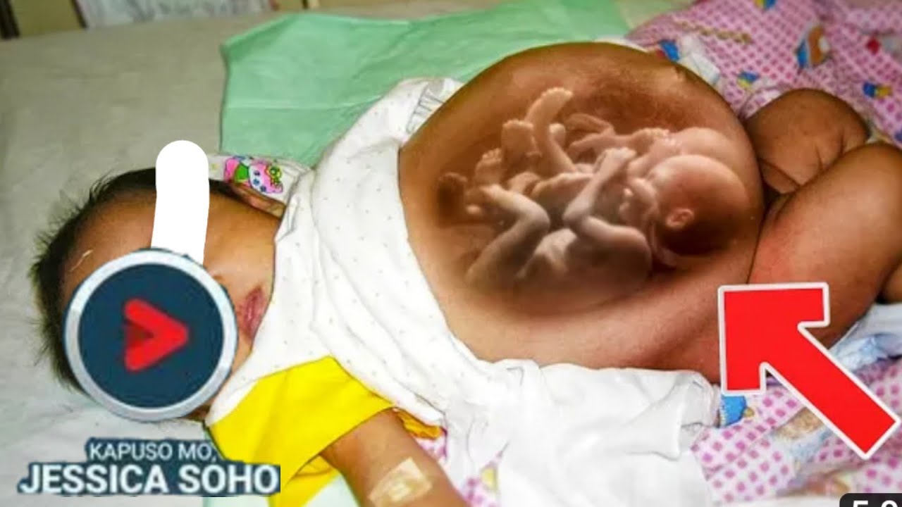KAPUSO MO, JESSICA SOHO SANGGOL NA IPINANGANAK NANG MAY FETUS SA TIYAN ...