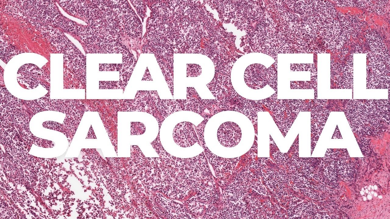 Clear Cell Sarcoma - YouTube