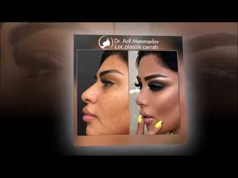 Rinoplastika əməliyyatından 3 ay sonra- Dr Arif Məmmədov Lor Plastik cərrah