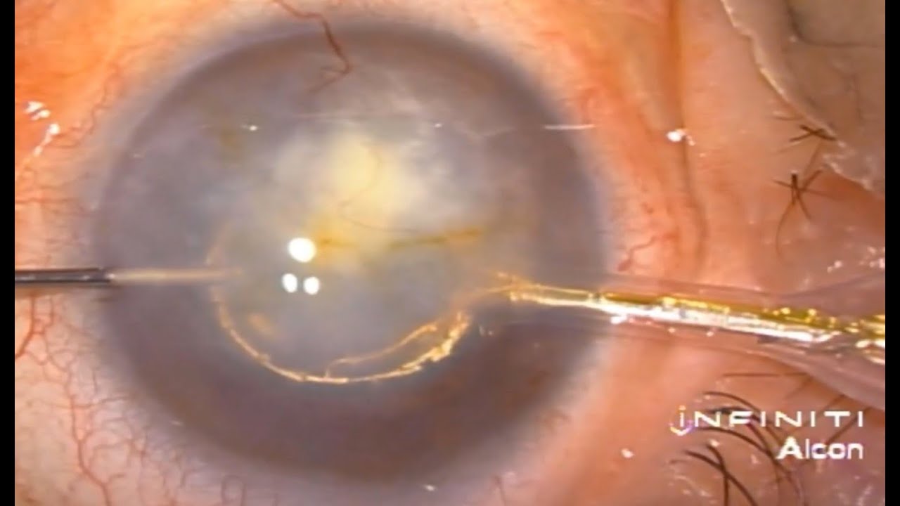 PKP triple operation using Zepto with corneal opacity case - YouTube