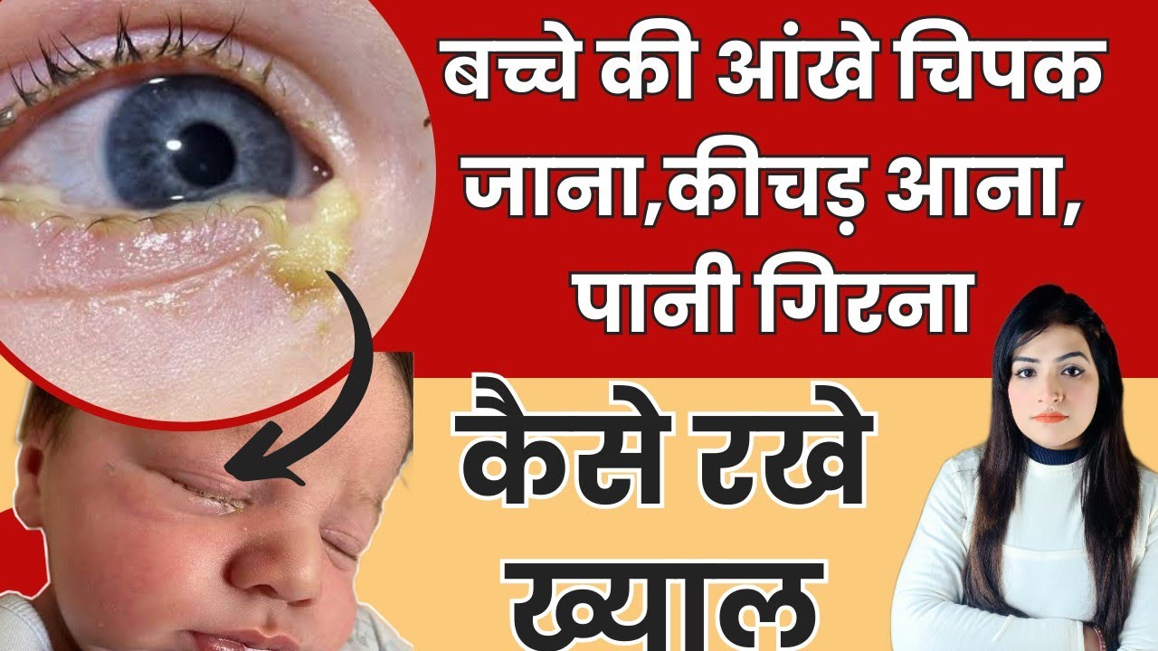 जानिए आंख से कीचड़ आना किन बीमारियों का है संकेत | How to treat sticky eyes | Eye caretaker ...