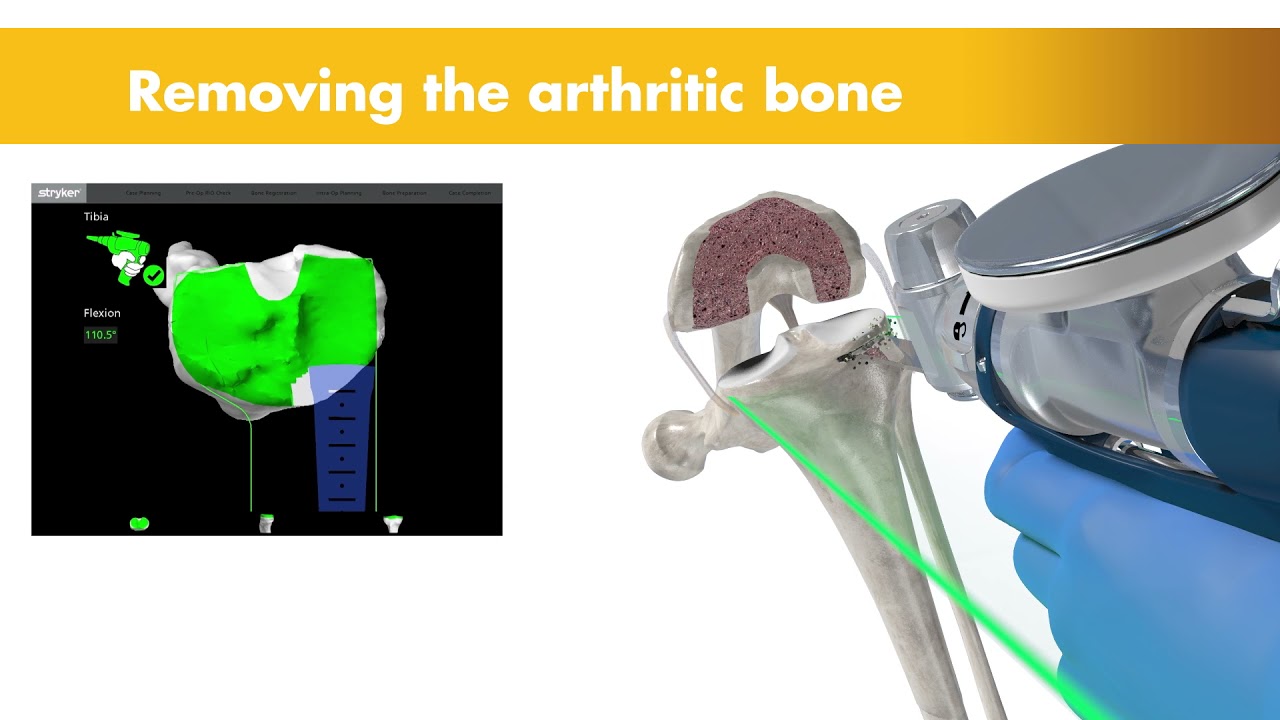 Mako Total Knee - Stryker - YouTube