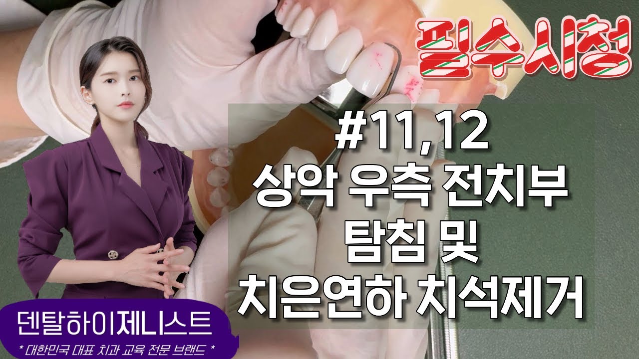 상악 우측 전치부 탐침 및 치은연하 치석제거 #11,12 Explorer, Gracey curette 익스플로러 그레이시큐렛 ...