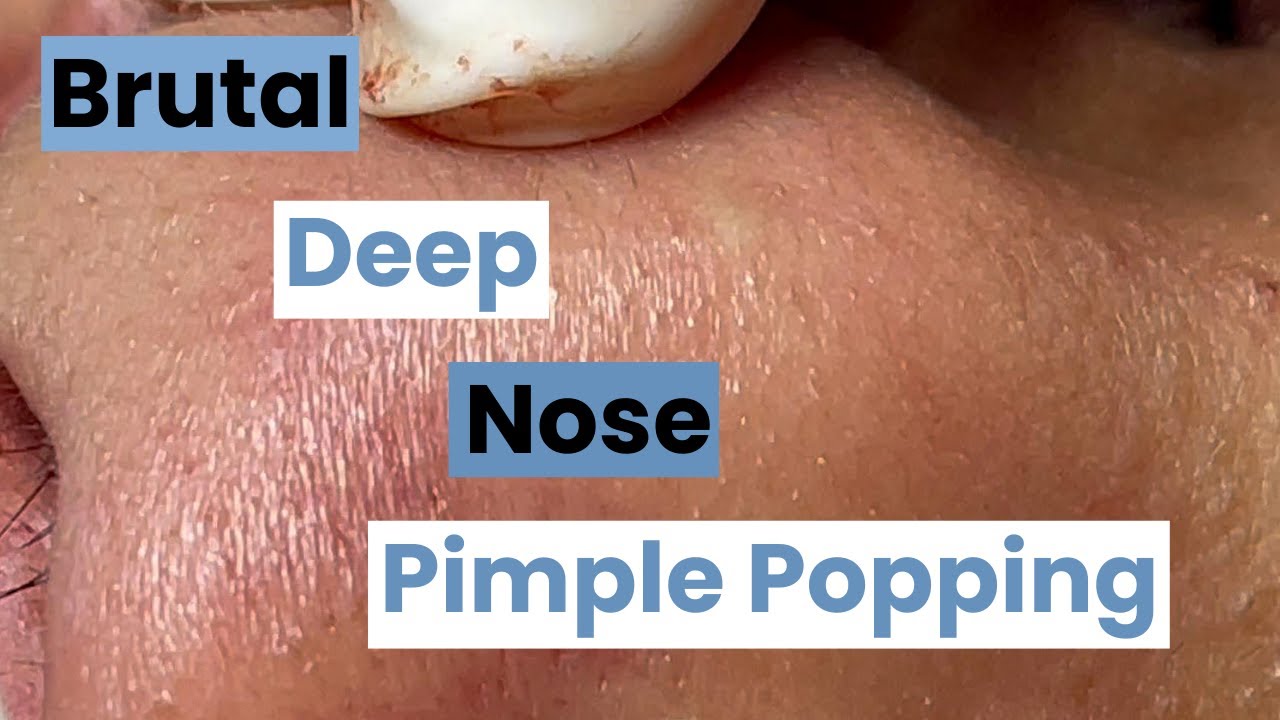 Brutal Deep Nose Pimple Popping — Dermatologist Real Time - YouTube