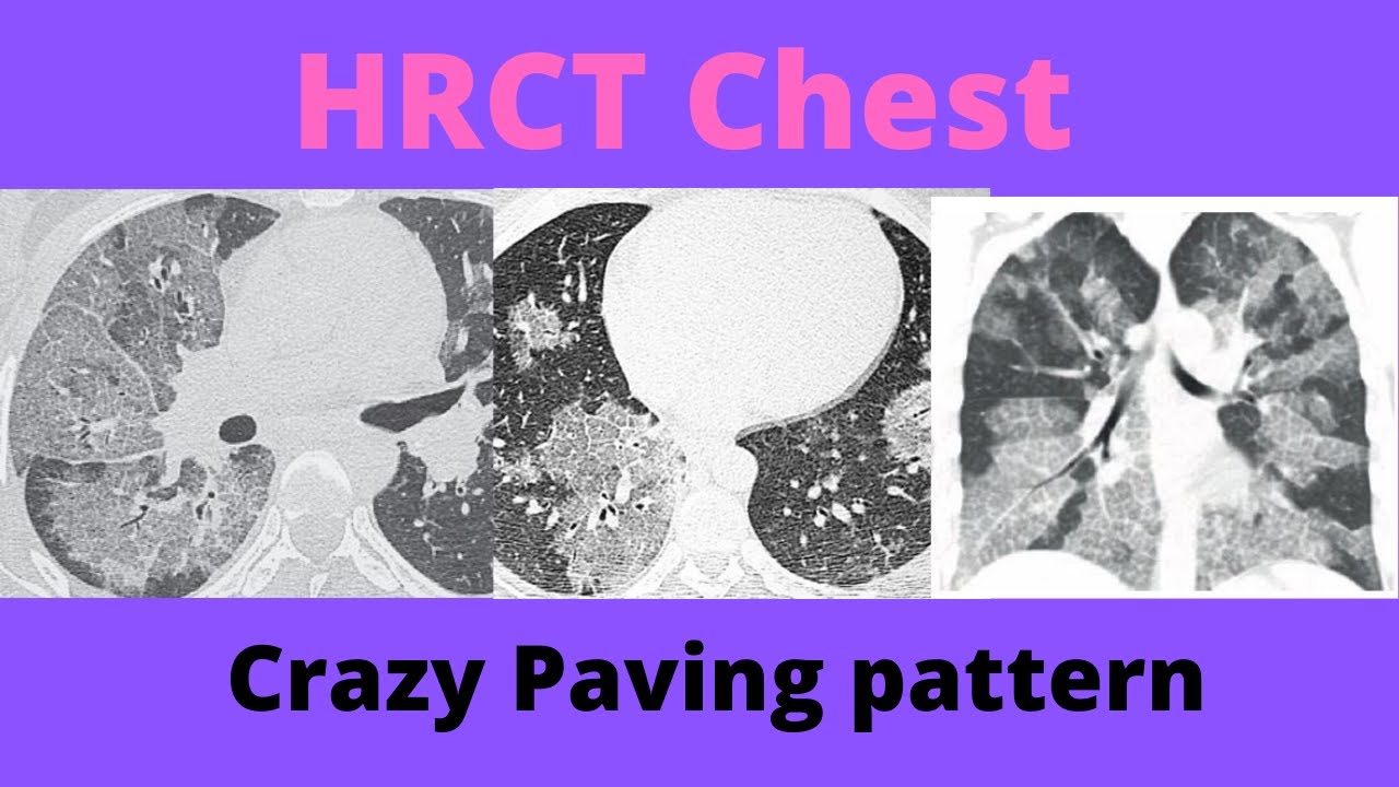 crazy paving pattern on HRCT Chest - YouTube