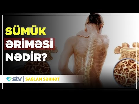 OSTEOPOROZ NƏDİR VƏ ONA DİAQNOZ NECƏ QOYULUR? - (18.04.2024)