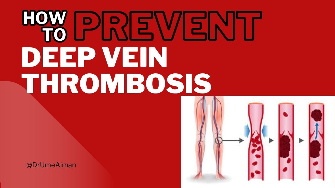 Deep Vein Thrombosis | How to prevent DVT? - YouTube