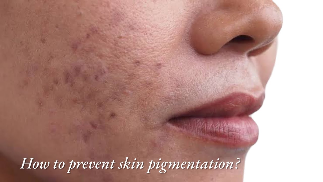 prevent your skin from pigmentation, skin tanning and early signs of ...