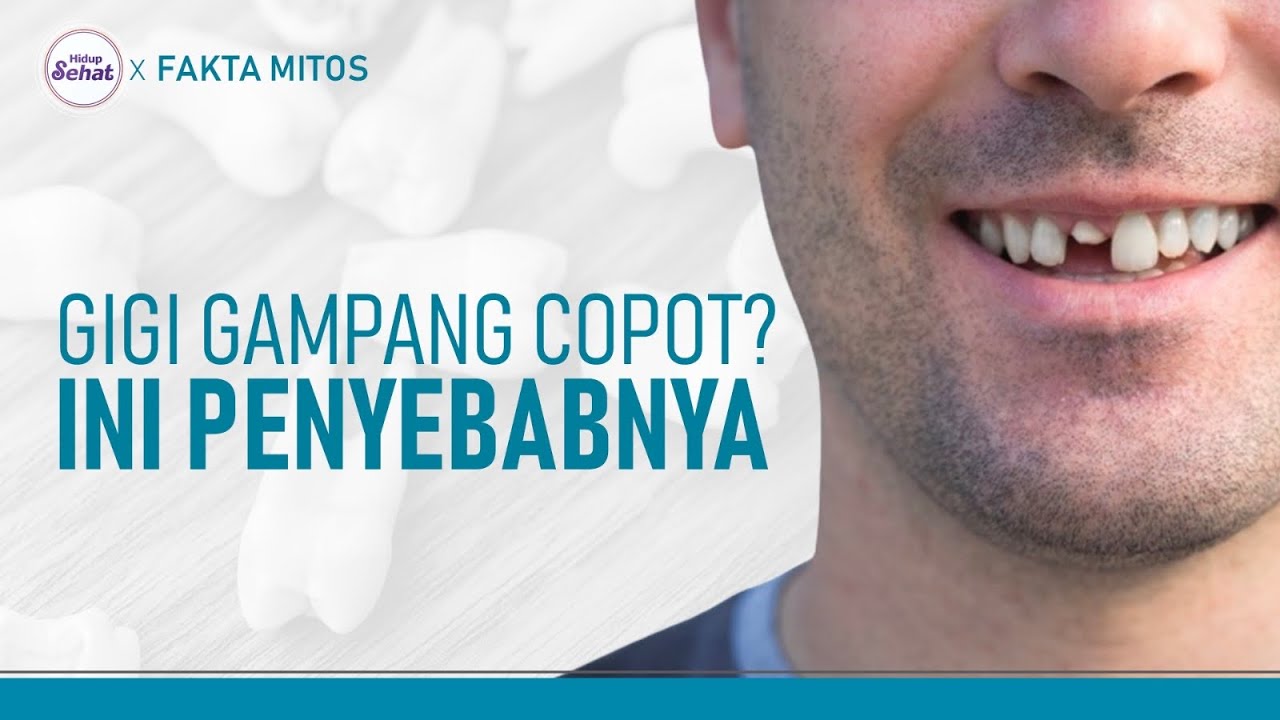 Penyebab Gigi Copot Pada Orang Dewasa, Bisa Jadi Tanda Penyakit ...