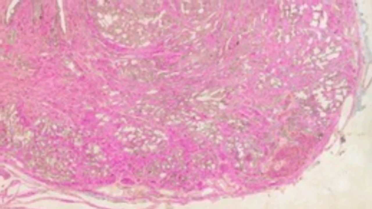 Prostate ultrasound-guided transrectal biopsy (Dr. JM Gil-Vernet) - YouTube