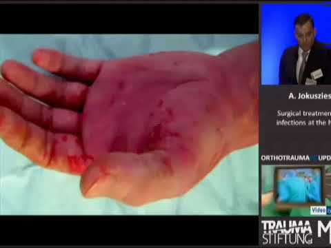Hand Infection and Operative therapy - YouTube