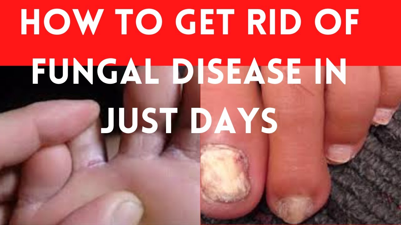 How to get rid of the fungal infection in 3-9 days: a simple method ...