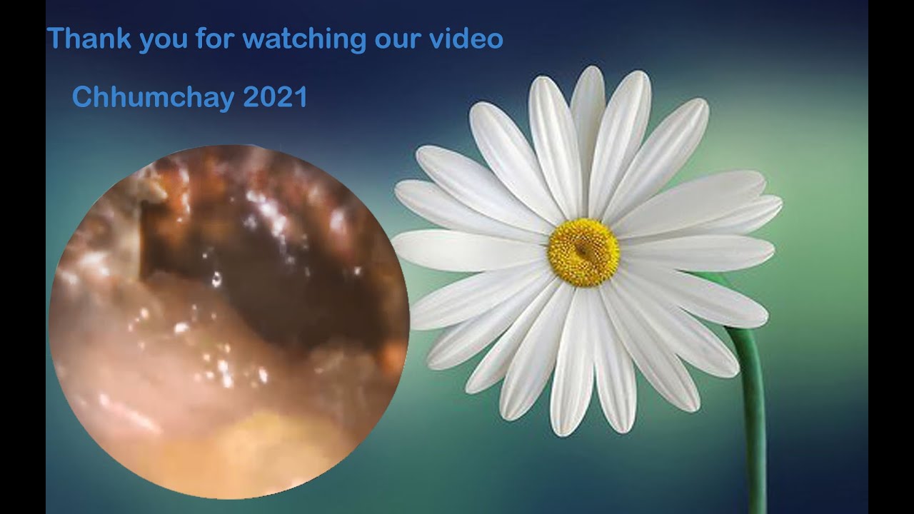 satisfy removal ear wax ep10 - YouTube