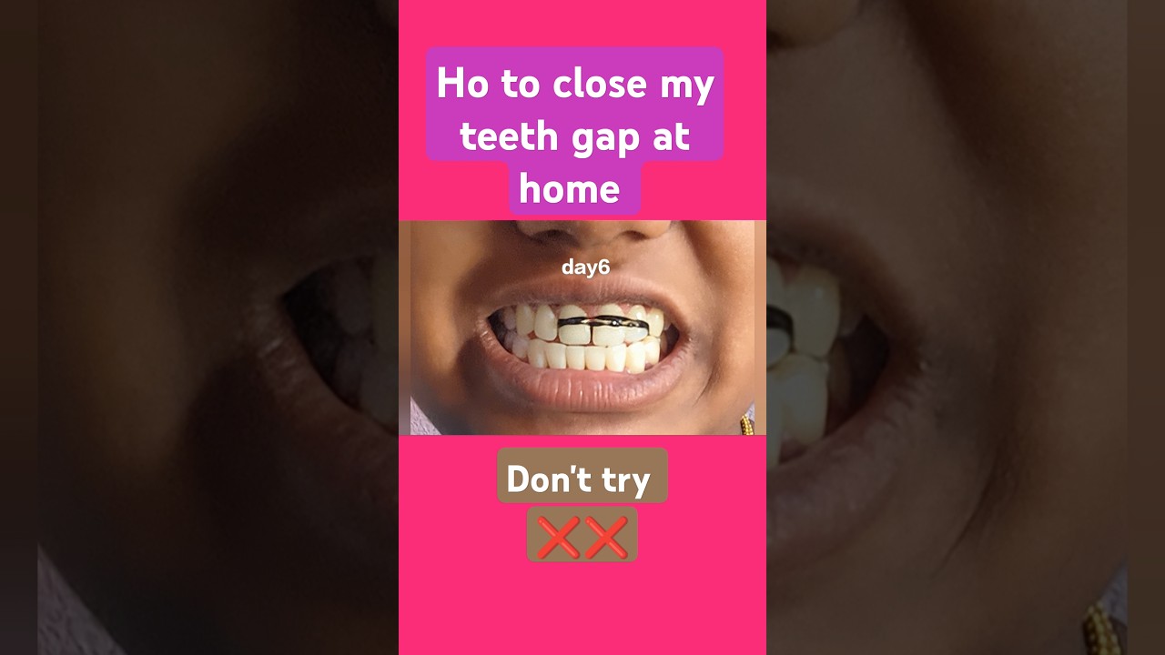 how to close my front teeth gap with rubber band|| front teeth gap ...