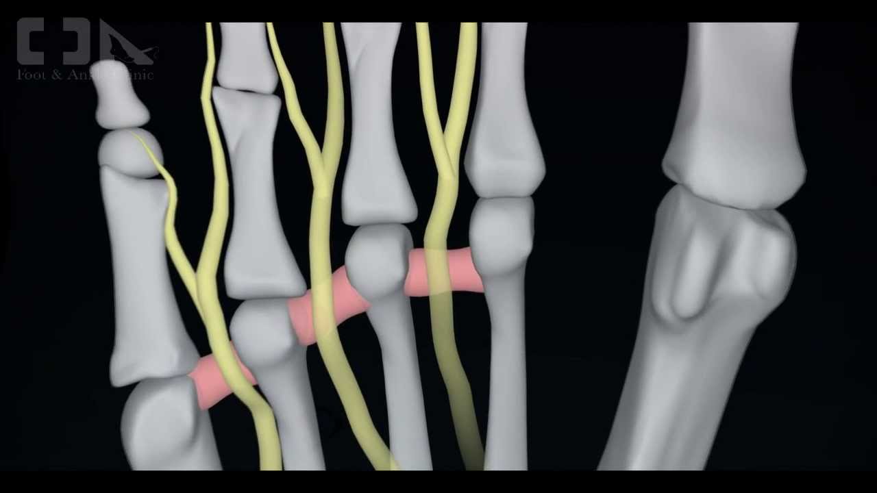 Minimally Invasive Morton's Neuroma Surgery - YouTube