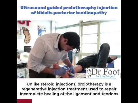 Ultrasound guided prolotheraphy injection of tibialis posterior ...