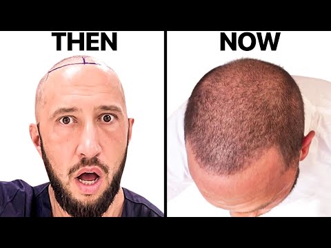I Got A $2000 Hair Transplant In Turkey | Surgeon Reacts