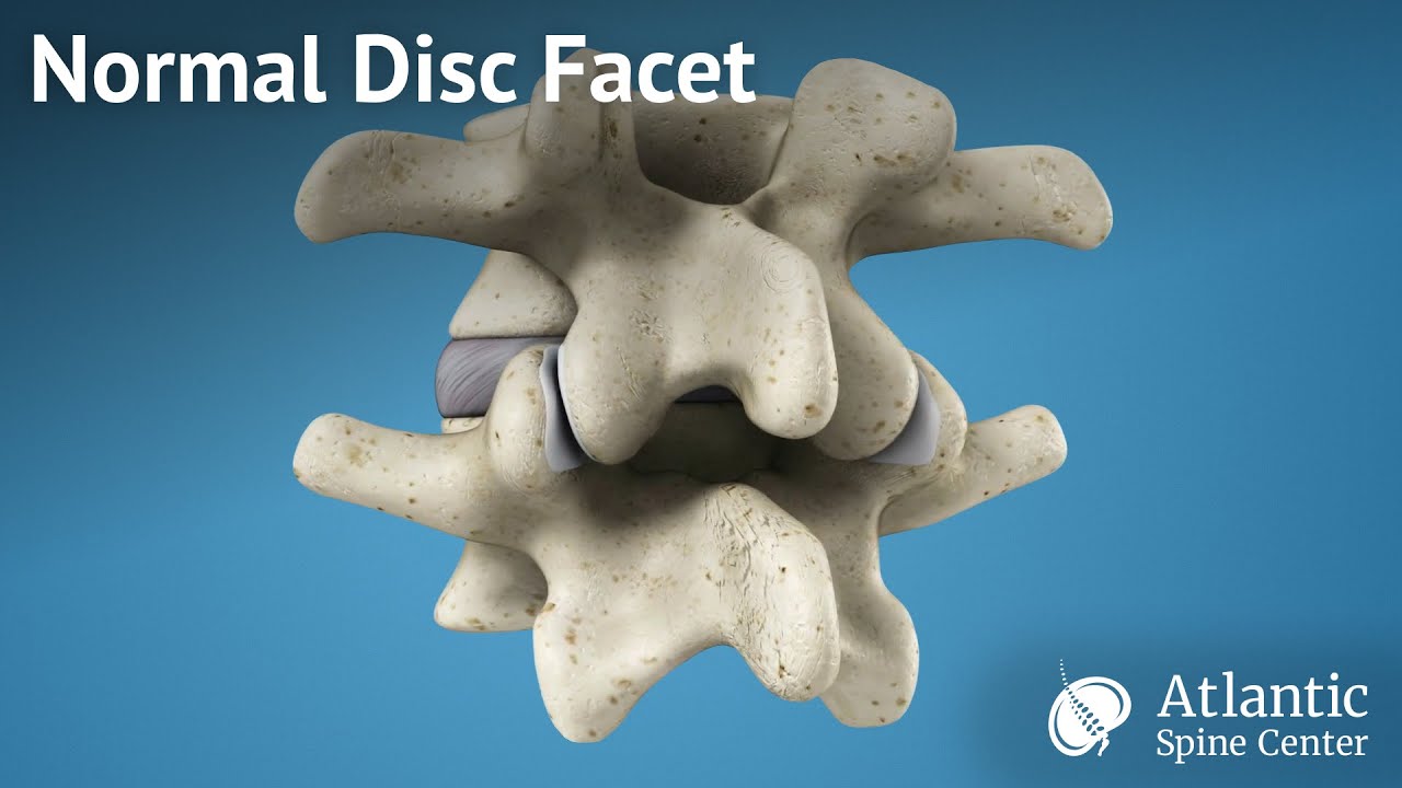 Normal Disc Facet - YouTube