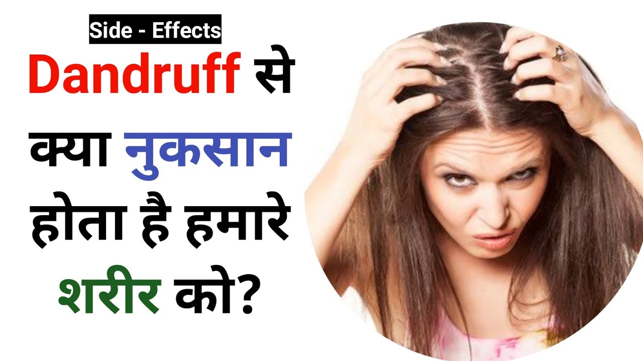 Dandruff Side Effects In Hindi @jppharmacy #dandruff #dandruffcontrol ...