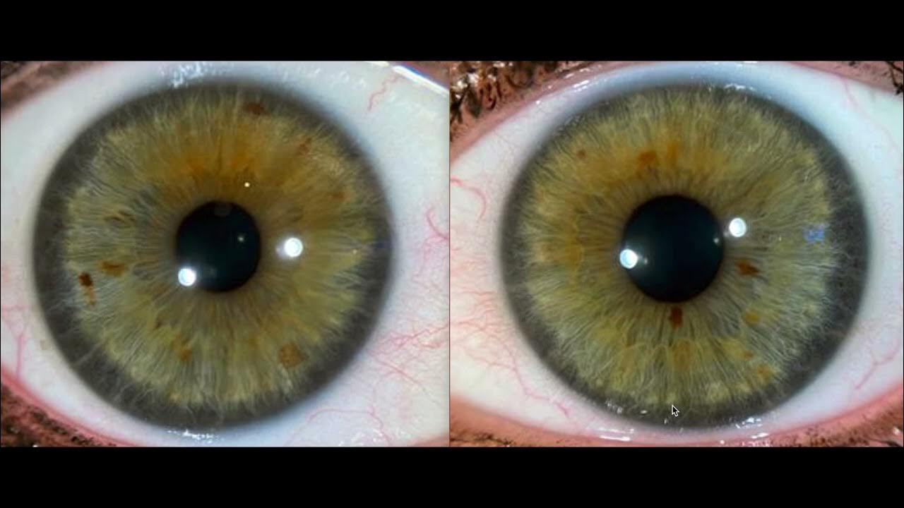 Iridology: A Quick Reading Example / Scurf Ring, Fermentation Signs, Kidney Lymphatic Diathesis ...