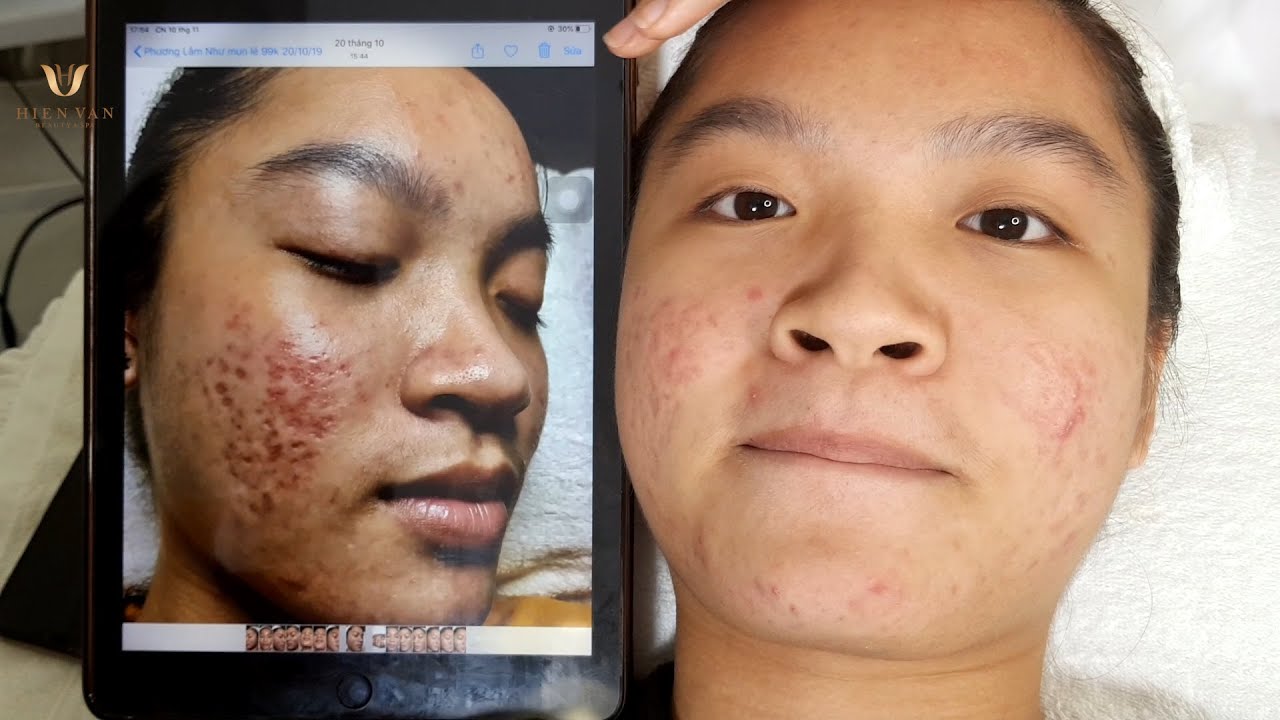 Review process of acne treament, blackheads, cysts of young girl at ...