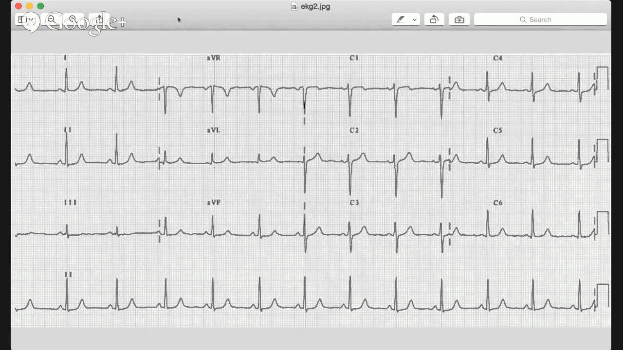EKG interpretation using Dubin's Method - YouTube