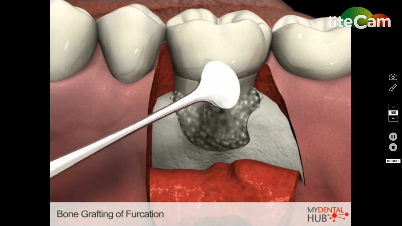 Guided Tissue Regeneration with Bone Grafting - YouTube