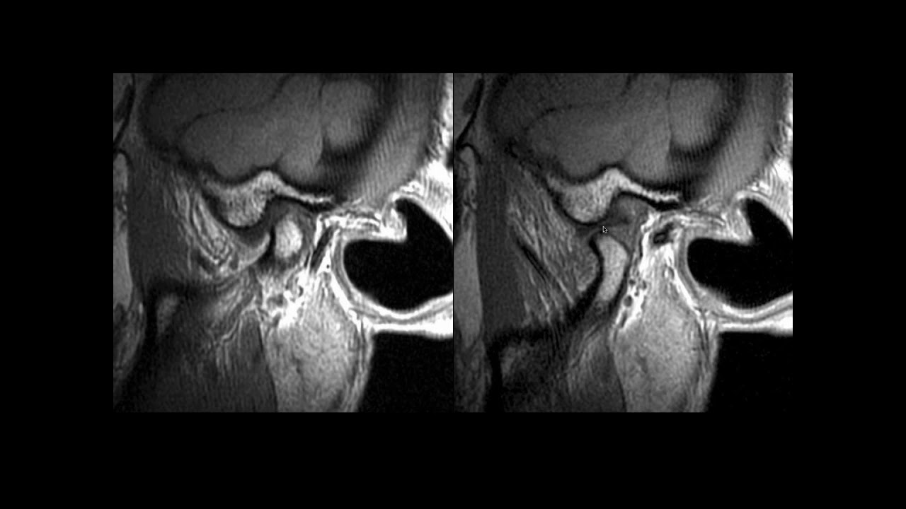 Tmj Mri