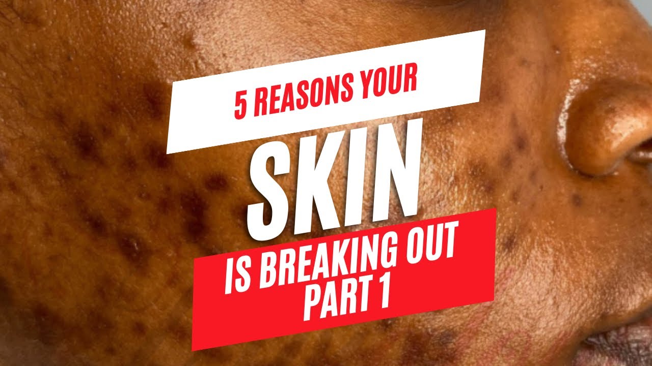5 REASONS YOUR SKIN IS BREAKING OUT! - YouTube