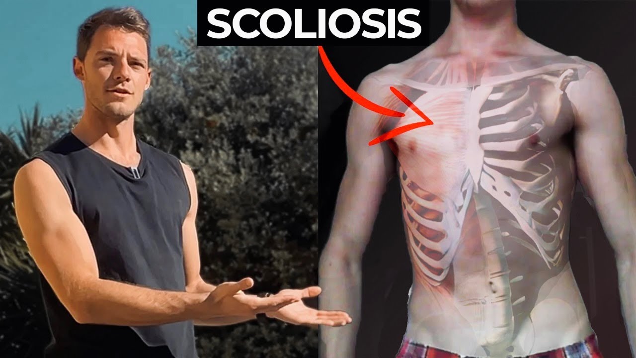 Did Barefoot fix my Scoliosis? - YouTube