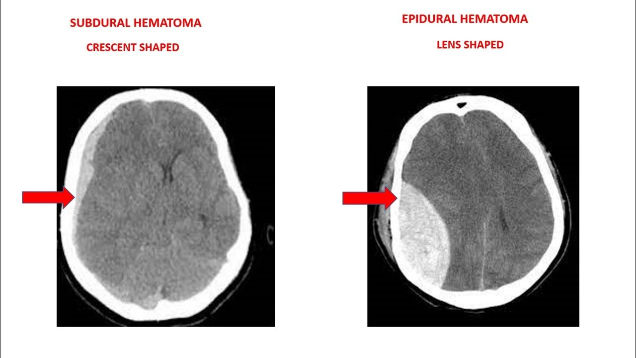 SUBDURAL VS EPIDURAL HEMATOMA - YouTube