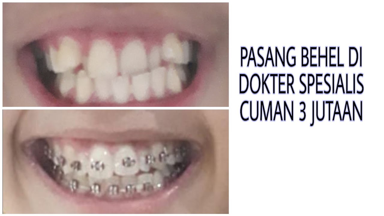 Biaya Pemasangan Behel Gigi + Perawatan di Drg. Spesialis Orthodontis ...