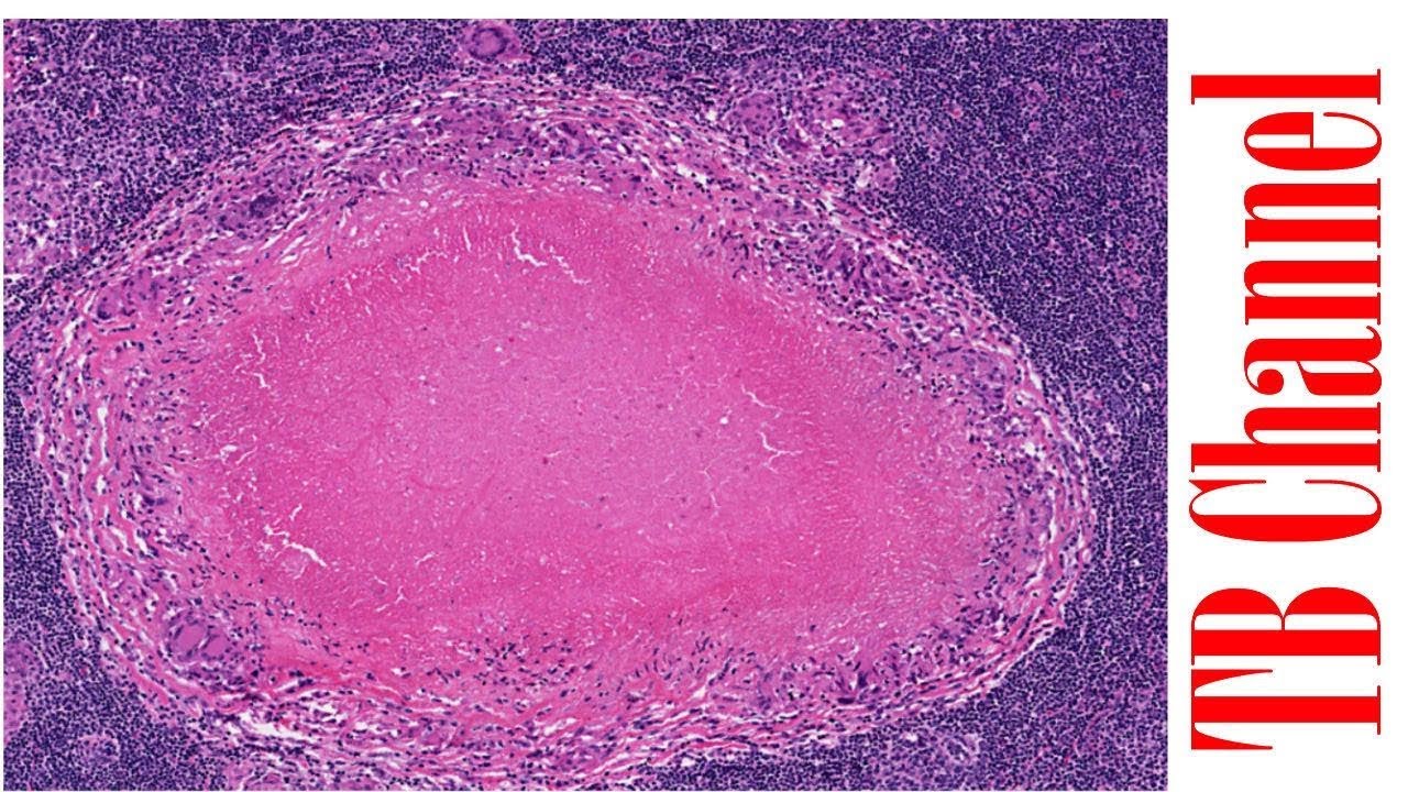 El granuloma de la tuberculosis - YouTube