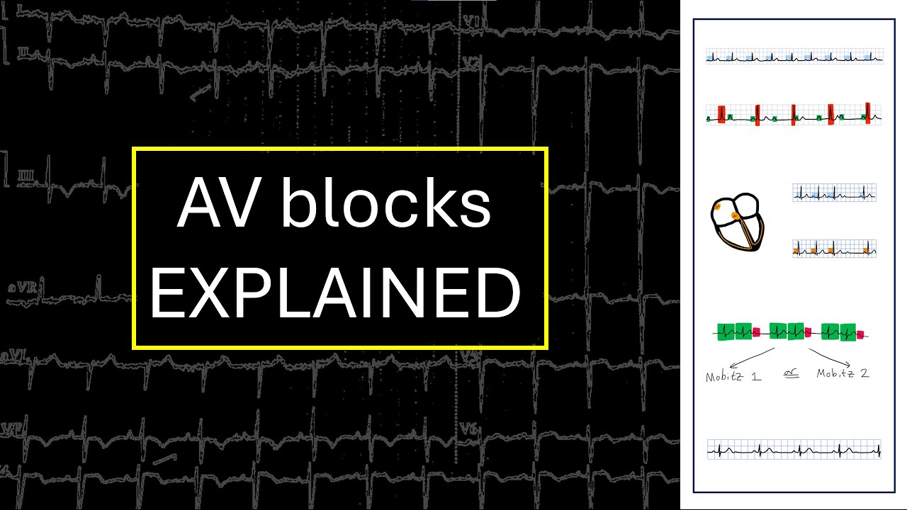 AV blocks | 1st, 2nd & 3rd degree - YouTube