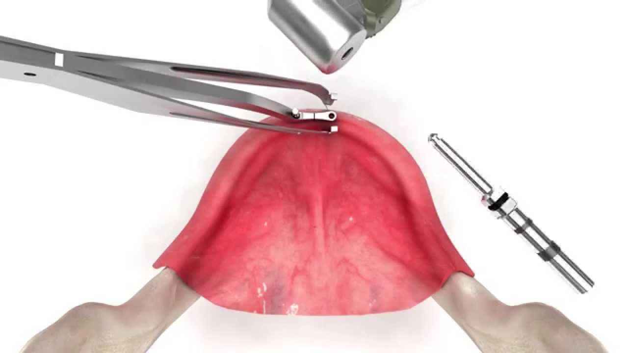 Easy2Fix Surgical Procedure - YouTube