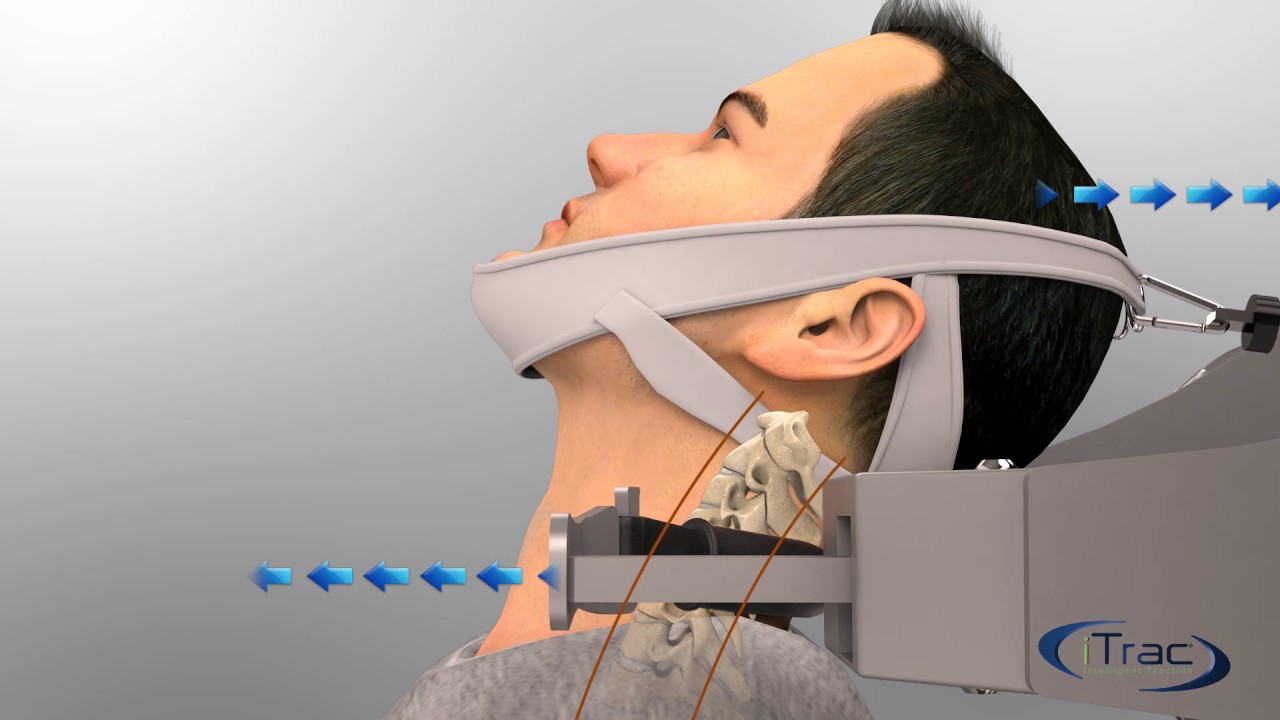 iTrac Spine Remodeling Technology - YouTube