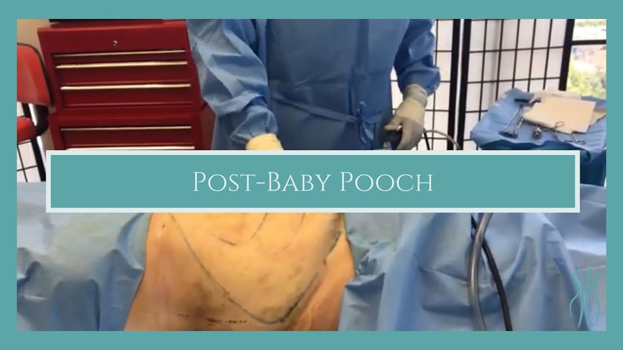Post-Baby Pooch - YouTube