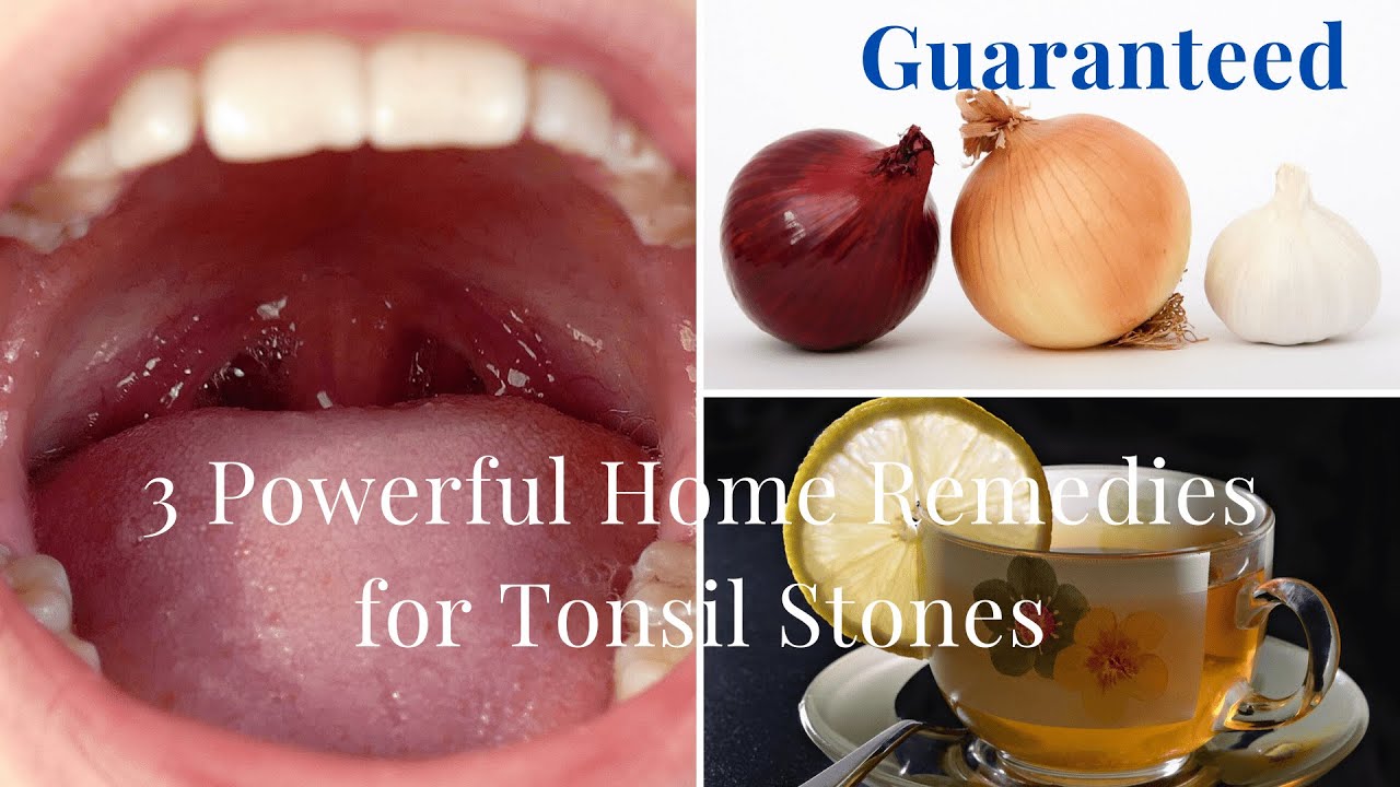 3 Powerful Home Remedies for Tonsil Stones - YouTube
