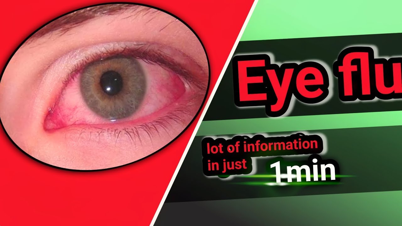 Eye flu क्या है।Eye flu कैसे होता है। - YouTube