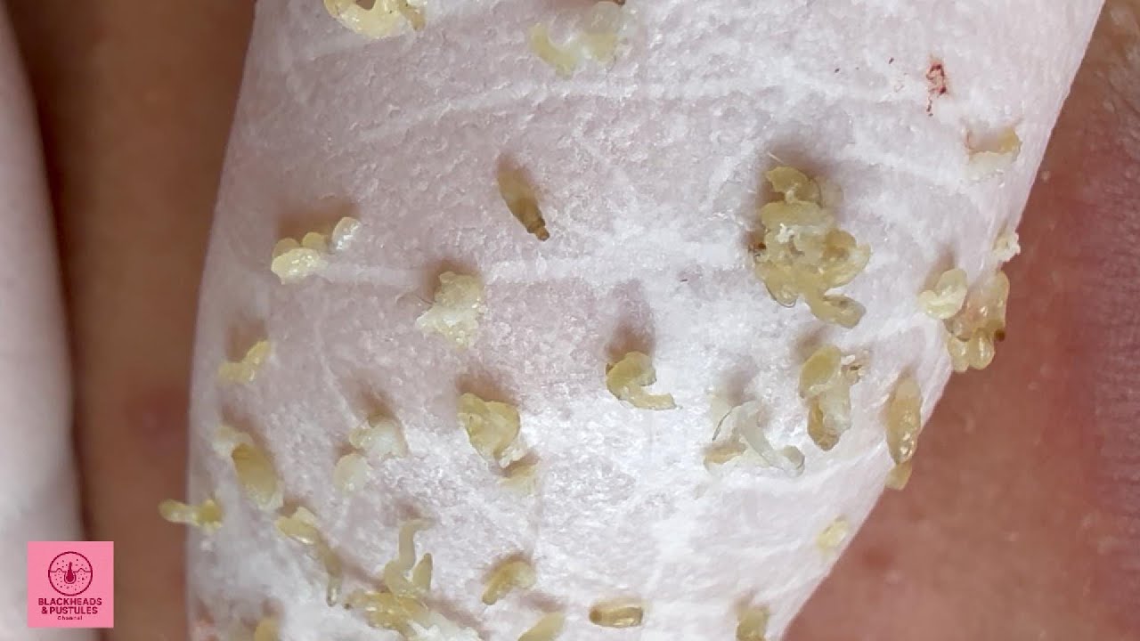 Suddenly, hidden pimples appear beneath seemingly normal skin - YouTube